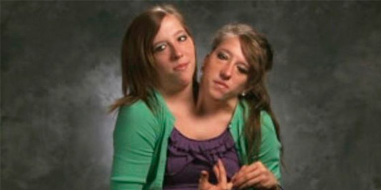 A história das gêmeas siamesas que dividem muito mais do que alguns órgãos